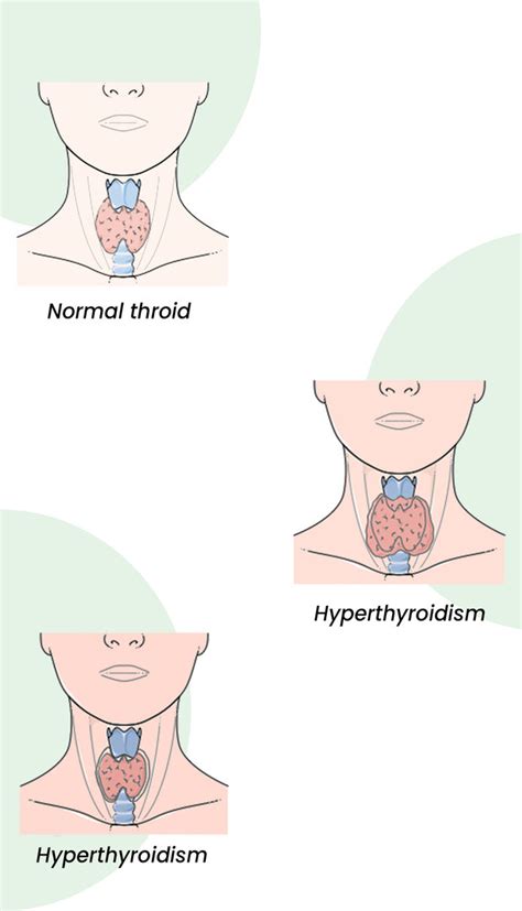 Thyroid And Itchy Skin Find The Link Symptoms And Treatment Options