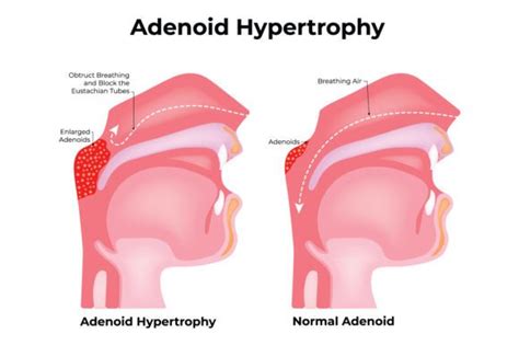 Adenoid Hypertrophy Science Design Graphic By Hamjaiu · Creative Fabrica