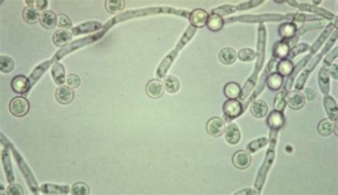 Vaginal Disorders Flashcards Quizlet