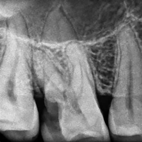 Detection Of Mb2 Canal In Maxillary First Molar Using Radiographic Download Table