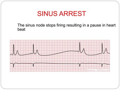 Sinus Node Dysfunction Pptx