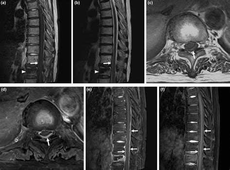 An 89 Year Old Woman With Acute Compression Fracture And Associated Download Scientific