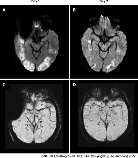 Autoimmune Encephalitis With Posterior Reversible Encephalopathy