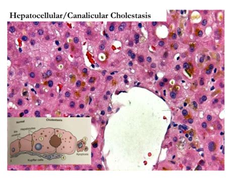 Cholestatic Pattern Liver Injury Flashcards Quizlet