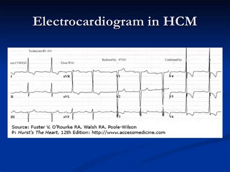 Hypertrophic Obstructive Cardiomyopathy Hocm