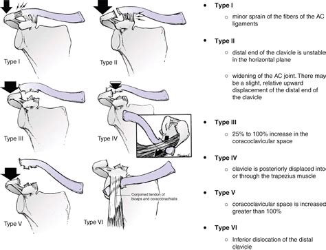 Ac Joint Tear Treatment At Karen Cutright Blog