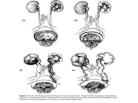 Urinary Tract Obstruction Pptx