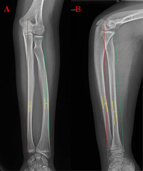 Measuring The Radius And Ulna Measurements The Length For Both Radius Download Scientific