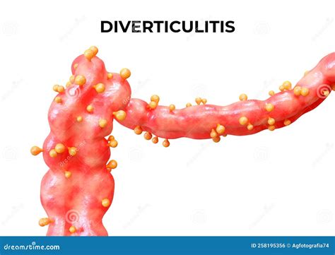 Diverticulitis And Diverticulosis Cartoon Vector 285500097
