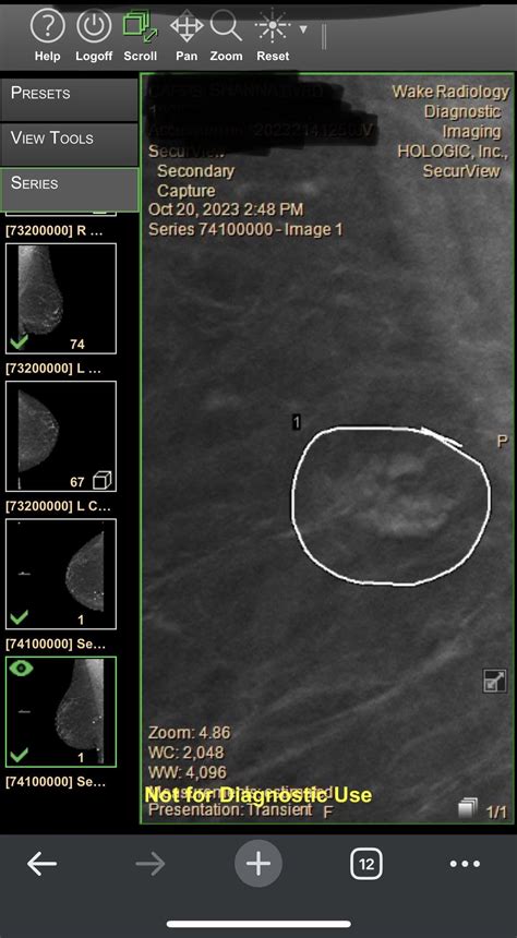 44f Asymmetry In Mammogram R Askdocs