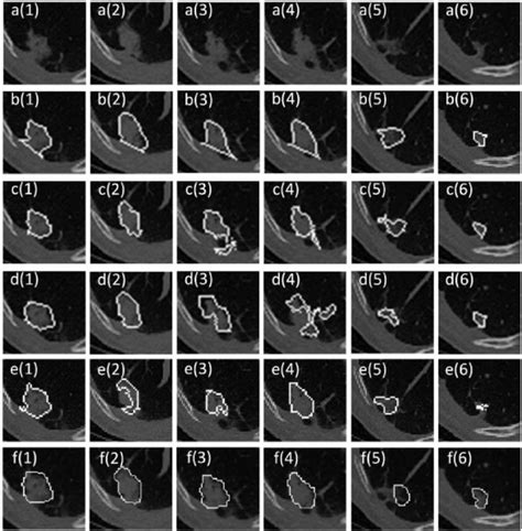 figure 1 from automatic lung nodule segmentation and intra nodular