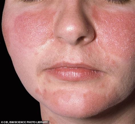 Eczema Rash On Cheeks At Nora Weeks Blog