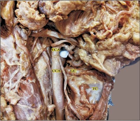 External Carotid Artery Branches Cadaver External Carotid Artery Branches Cadaver
