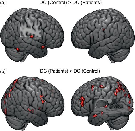 Resting State Activity Using Degree Centrality Analysis Dc Main Download Scientific Diagram