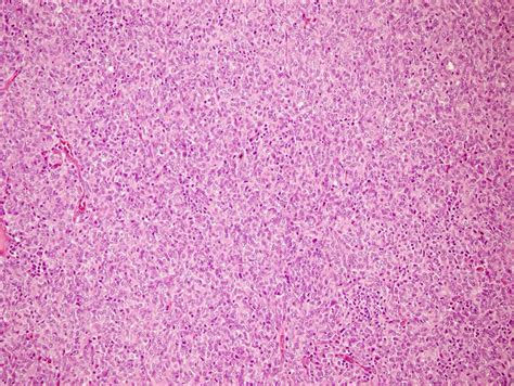 Pathological Analysis Of Specimen As A Type Ab Thymoma Consisting Of Download Scientific