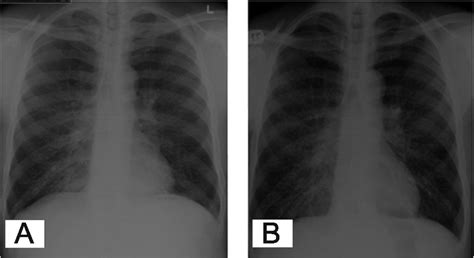 Primary Pulmonary Mucosa Associated Lymphoid Tissue Lymphoma In A