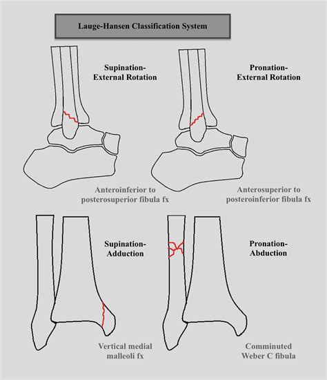 Pronation Abduction Ankle Fracture