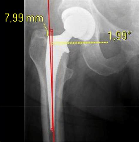 Radiograph In Ap Projection With A Collared Corail® Stem The Download Scientific Diagram