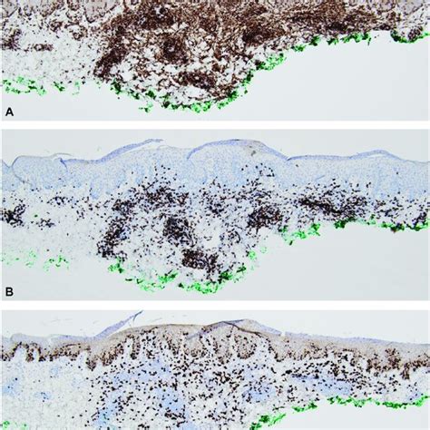 A Cd4 Immunohistochemical Staining At 43 Magnification Showing Diffuse