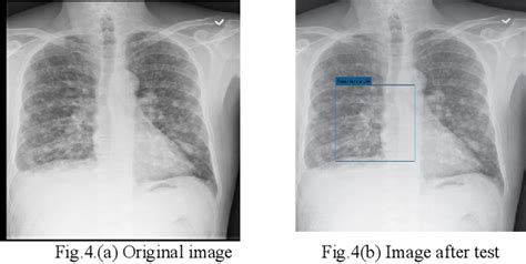 Table 2 From An Automatic Detection Of Pneumonia From Chest Ionizing Radiation Images Using