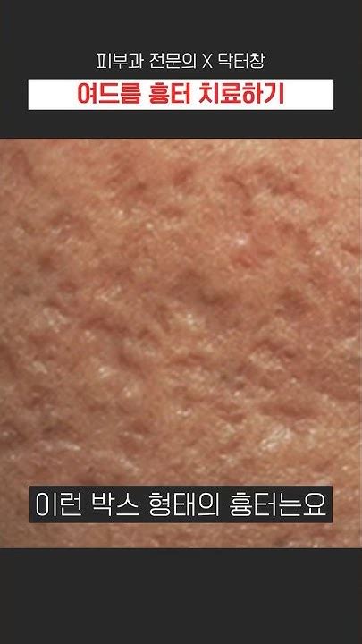 여드름 흉터 치료하는 방법 여드름 여드름흉터 피부관리 꿀팁 Youtube