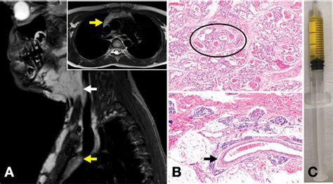 Diffuse Vascular Proliferation In The Cervical Region White Arrow