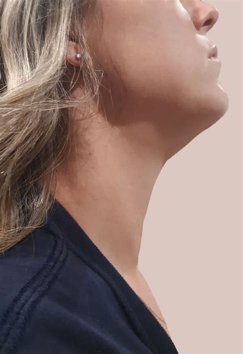 Thyroid Ablation Thyroid Rfa Starmed America