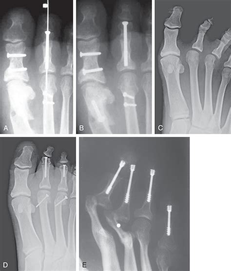 Lesser Toe Deformities Clinical Tree