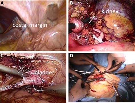 Complete Laparoscopic Nephroureterectomy For The Upper Urinary Tract