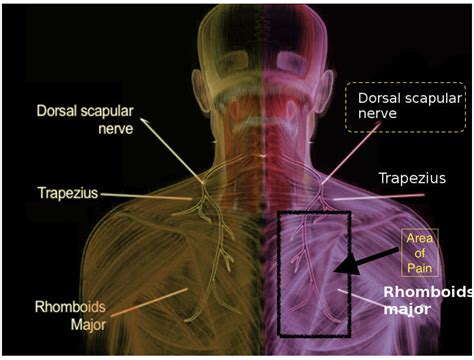 Dorsal Scapular Nerve Patient Information Sheets