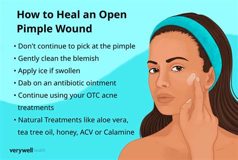 Antibiotic Ointment For Popped Pimple At Genevieve Tarrant Blog
