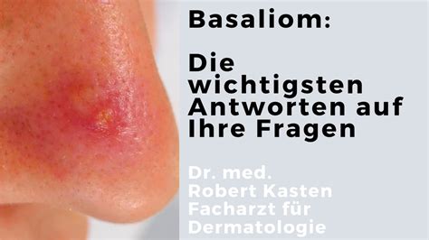 Basaliombasalzellkarzinom Hautarzt Dr Kasten Mainz