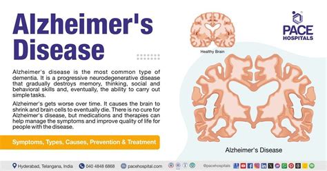 Alzheimers Disease Causes