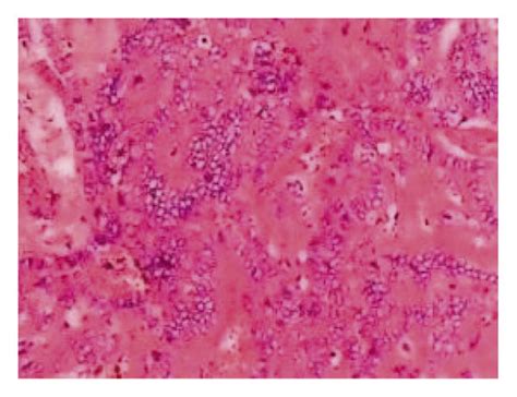 Pathological Classification Of Thyroid Cancer Download Scientific Diagram