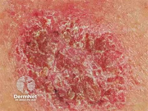 Xerosis Definition Asteatotic Eczema What It Is What To Do