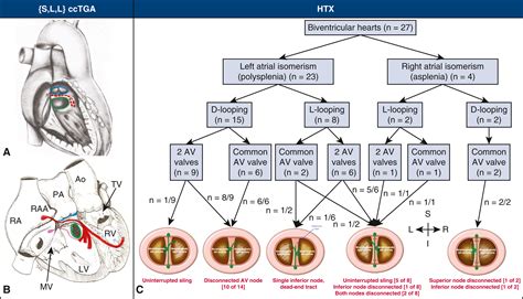 Conduction In Congenital Heart Surgery The Journal Of Thoracic And