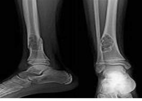 Figure 2 From Aneurysmal Bone Cyst Primary About Eight Pediatric