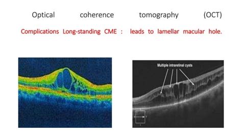 Cscr Central Serous Chorioretinopathy Pptx Eye And Vision Conditions Diseases And