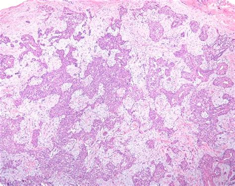 Glomus Tumor Pathology Orthobullets