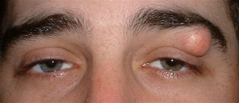 Cyst Under Eyebrow