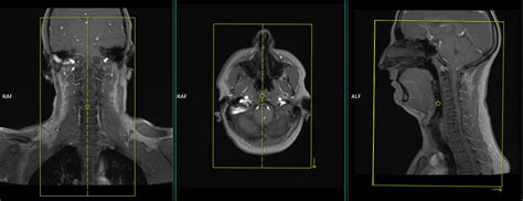 Magnetic Resonance Angiography Mra Neck Dissection Protocols And Planning