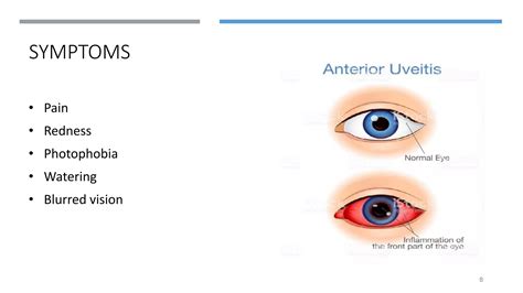 Acute Anterior Uveitis By Dr Rubanapptx