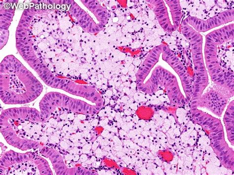 Cholesterolosis Microscopic Features