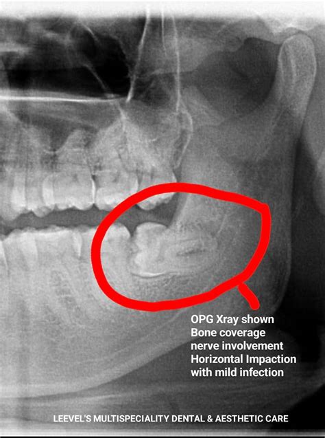 Dr Vishanth On Linkedin Horizontal Wisdom Teeth Surgical Impaction Surgery Done