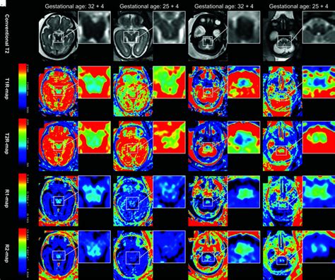 Mapping Human Fetal Brain Maturation In Vivo Using Quantitative Mri Pmc