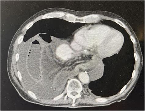 Recurrent Hiatal Hernia Causing Small Bowel Obstruction Secondary To