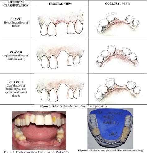 Siebert Classification Edentulous Ridge Siebert Classification Edentulous Ridge