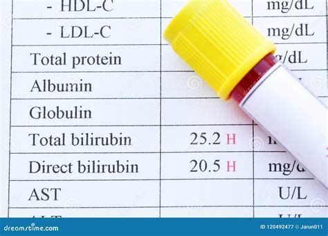 Abnormal High Bilirubin Test Result Stock Image Image Of Clinical Conjugated 120492477