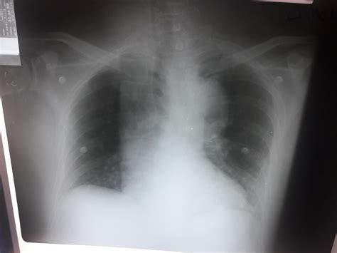 Figure 1 Cxr Widened Mediastinum Khidir Pocus Journal