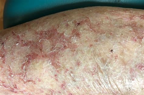 Dermatitis In The Elderly